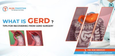 What is GERD? Tips for Recovering from GERD surgery