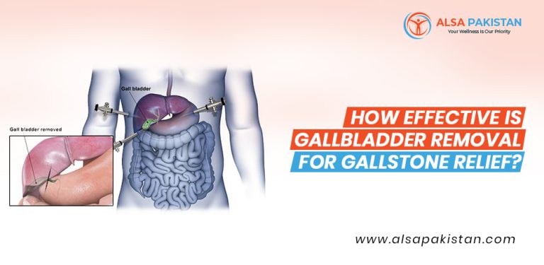 Everything you should know about Gallbladder removal surgery